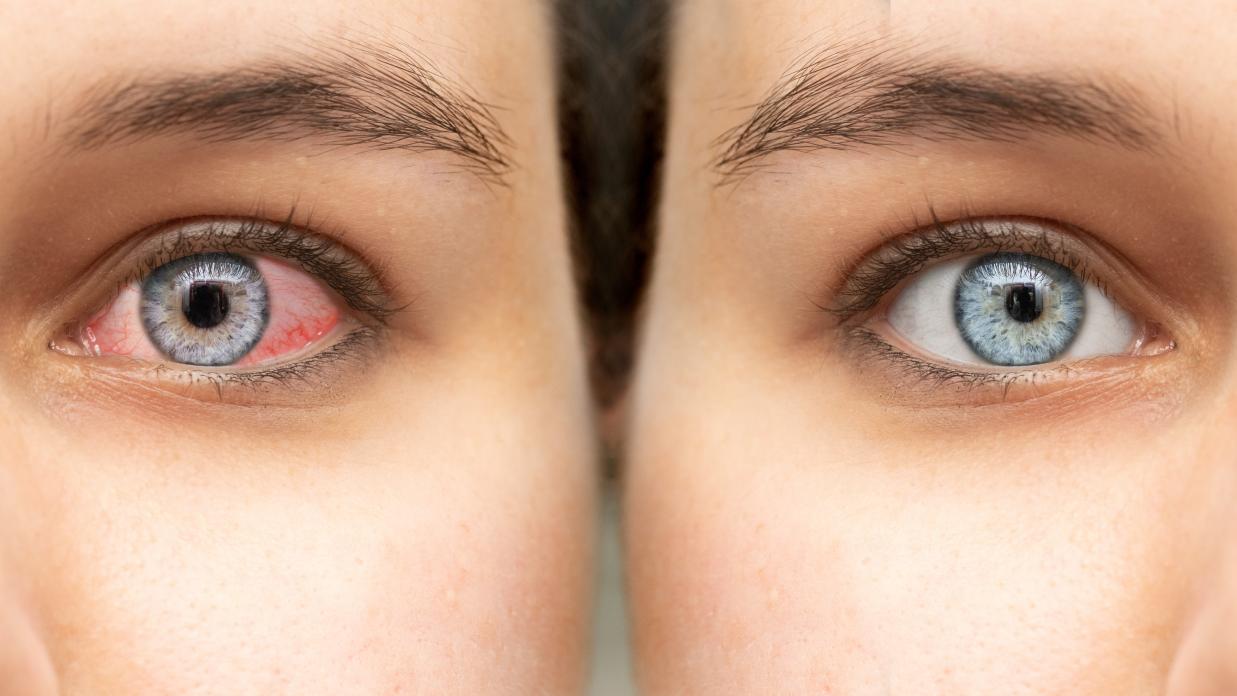 Pink Eye Is Unsightly and Uncomfortable - HealthSmarted.com